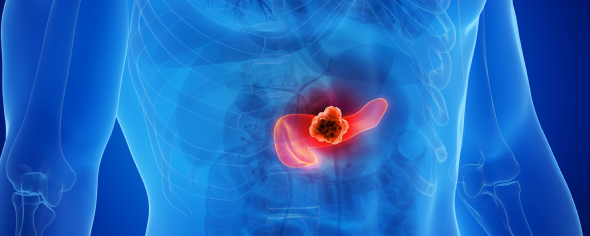 Treatment with Low-Energy Electric Fields Ups Pancreatic Cancer ...