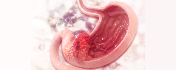 GSK Buys Gastrointestinal-Focused Biopharma | Cancer Discovery News ...