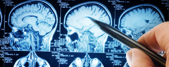 BrainChild-03 Trial Supports Safety of B7-H3 CAR T-cell Therapy for DIPG | Cancer Discovery News ...