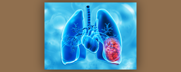 GUK1 Represents a Metabolic Dependency in ALK+ Lung Cancer | Cancer ...