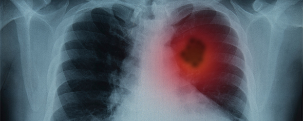 ADC Granted Accelerated Approval for NSCLC | Cancer Discovery News ...