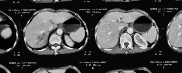 Everyday CT Scans Flag Signs of Stomach Cancer | Cancer Discovery News ...