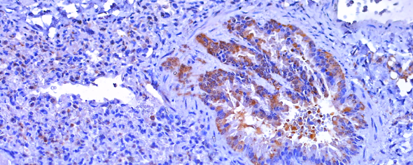 Basal Origin Linked to Lineage Plasticity in Small Cell Lung Cancer ...