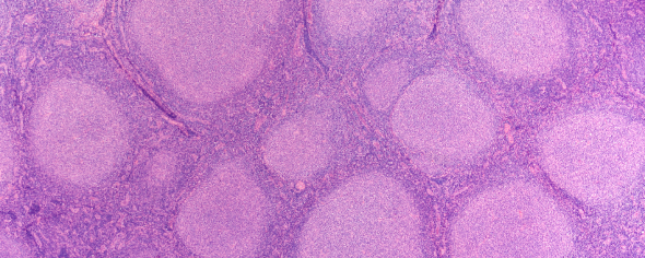 Bispecific Approved for NHL Subtype | Cancer Discovery News | American ...