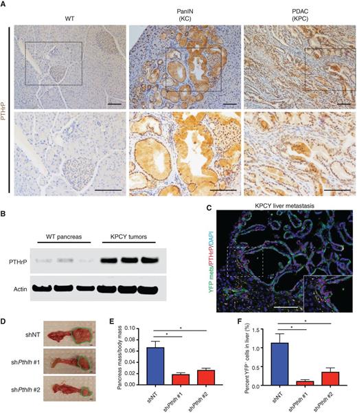 PTHrP Drives Pancreatic Cancer Growth and Metastasis and Reveals a New ...