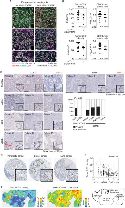 Spatial Positioning and Matrix Programs of Cancer-Associated ...