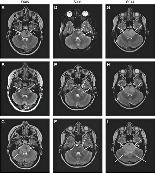 Intraventricular B7-H3 CAR T Cells for Diffuse Intrinsic Pontine Glioma ...
