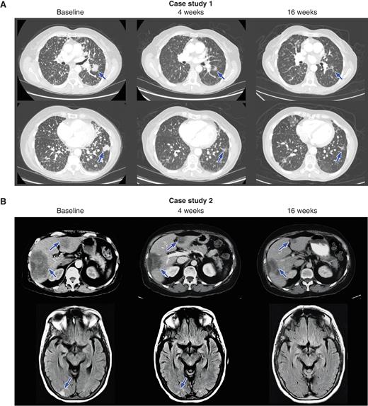 NVL-520 Is a Selective, TRK-Sparing, and Brain-Penetrant Inhibitor of ...