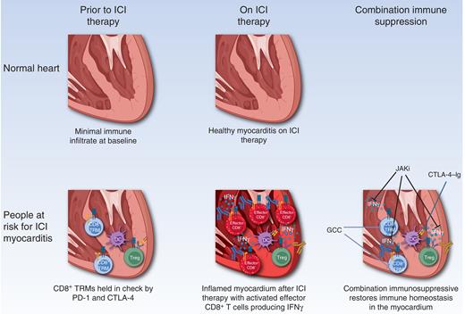 Weighing Antitumor Immunity against Life-threatening Myocarditis from ...
