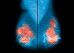 Synchronous Bilateral Breast Cancers Are Distinct Diseases | Cancer ...
