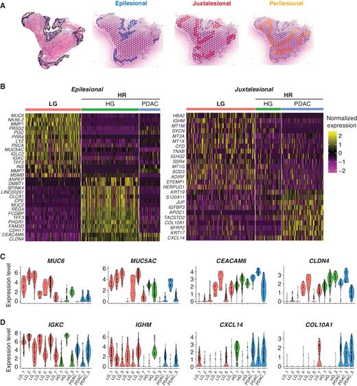 Spatial Transcriptomics of Intraductal Papillary Mucinous Neoplasms of ...