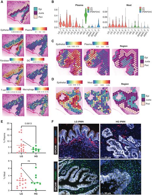 Spatial Transcriptomics of Intraductal Papillary Mucinous Neoplasms of ...