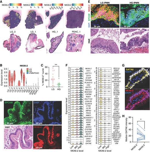 Spatial Transcriptomics of Intraductal Papillary Mucinous Neoplasms of ...