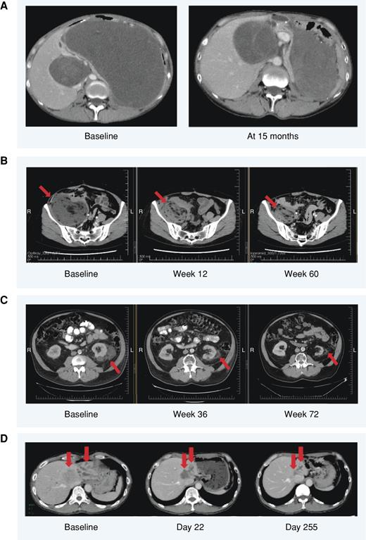 The MDM2–p53 Antagonist Brigimadlin (BI 907828) in Patients with ...