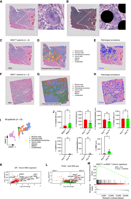 TREM2-Expressing Multinucleated Giant Macrophages Are a Biomarker of ...