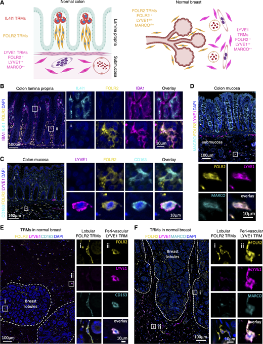 Spatially Segregated Macrophage Populations Predict Distinct Outcomes ...