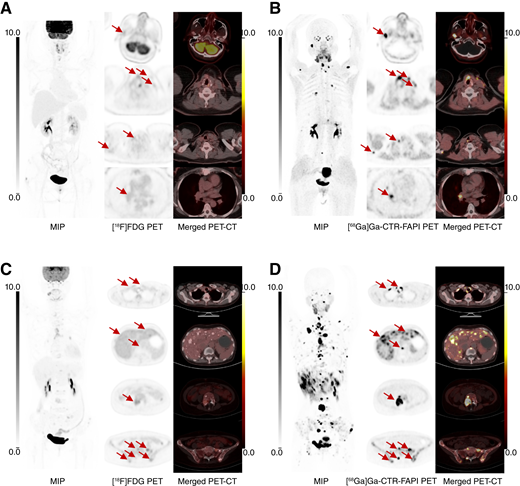 CTR-FAPI PET Enables Precision Management of Medullary Thyroid ...