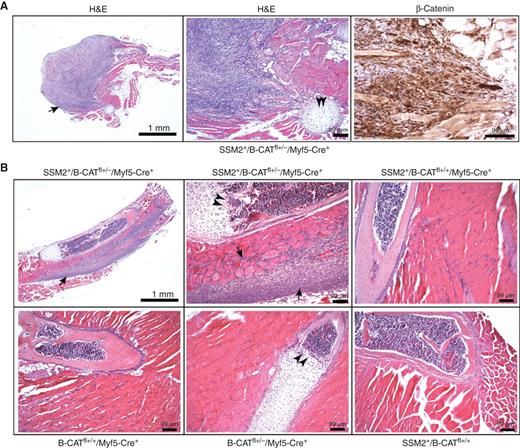 Targeting the Wnt Pathway in Synovial Sarcoma Models | Cancer Discovery ...