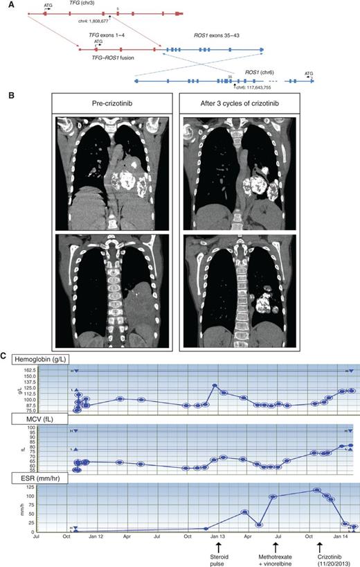 Inflammatory Myofibroblastic Tumors Harbor Multiple Potentially ...