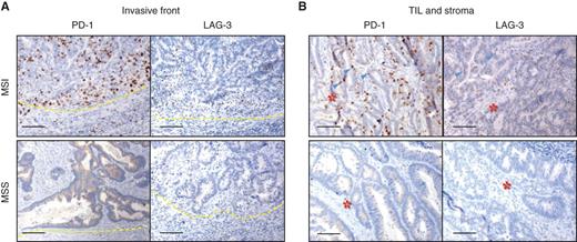 The Vigorous Immune Microenvironment of Microsatellite Instable Colon ...