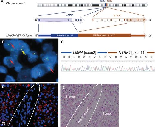 An Oncogenic NTRK Fusion in a Patient with Soft-Tissue Sarcoma with ...