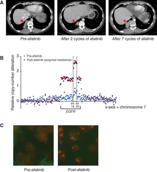 EGFR Kinase Domain Duplication (EGFR-KDD) Is a Novel Oncogenic Driver ...