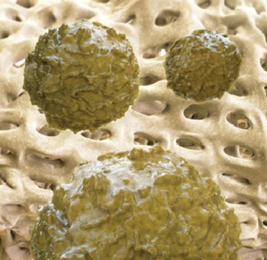 PTPN11 Mutations in the Bone Marrow Microenvironment Induce Leukemia ...