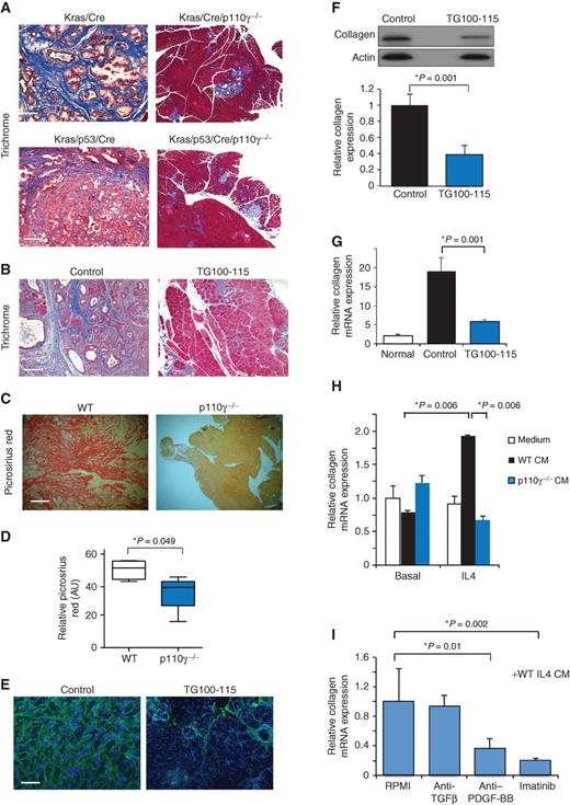 Macrophage PI3Kγ Drives Pancreatic Ductal Adenocarcinoma Progression ...