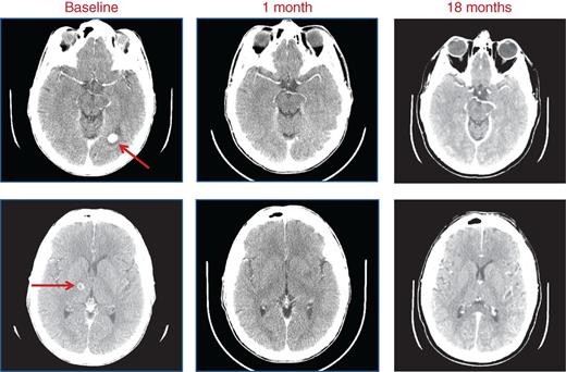 Safety and Antitumor Activity of the Multitargeted Pan-TRK, ROS1, and ...