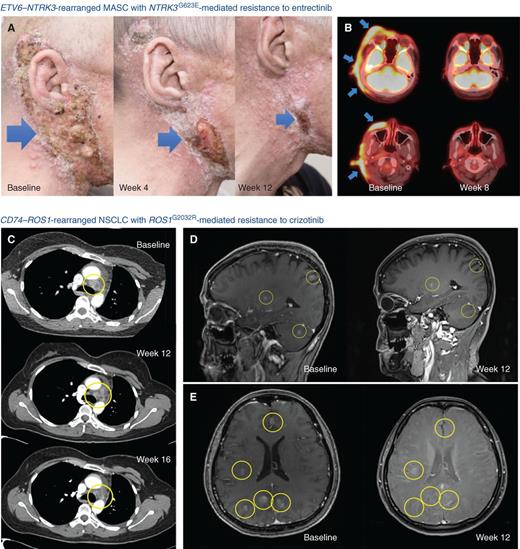 Repotrectinib (TPX-0005) Is a Next-Generation ROS1/TRK/ALK Inhibitor ...