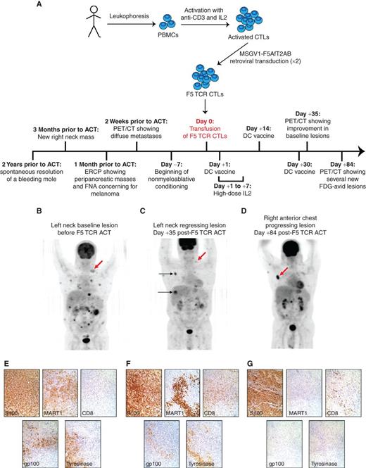 Immunotherapy Resistance by Inflammation-Induced Dedifferentiation ...