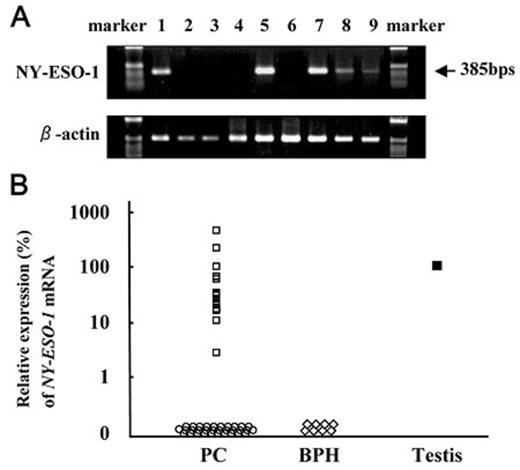 NY-ESO-1 mRNA expression and immunogenicity in advanced prostate cancer ...