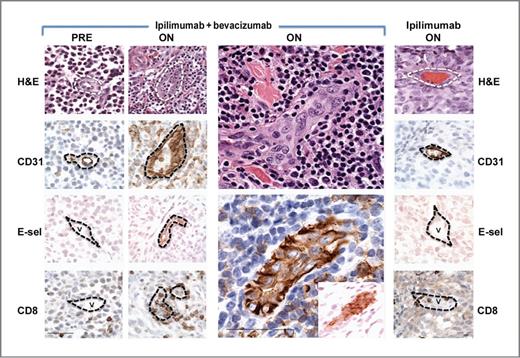 Bevacizumab plus Ipilimumab in Patients with Metastatic Melanoma ...