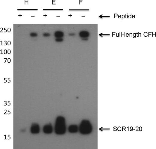 Complement Factor H Antibodies from Lung Cancer Patients Induce ...