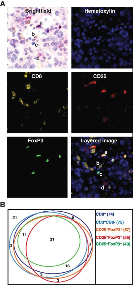 CD25 Identifies a Subset of CD4+FoxP3− TIL That Are Exhausted Yet ...