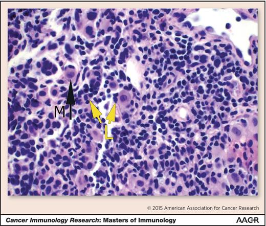 Reflections on the Histopathology of Tumor-Infiltrating Lymphocytes in ...
