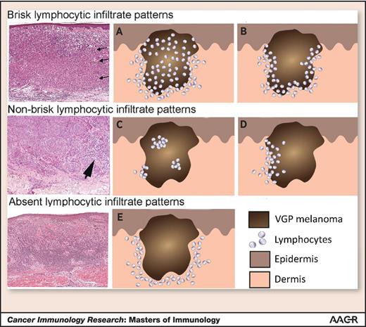 Reflections on the Histopathology of Tumor-Infiltrating Lymphocytes in ...