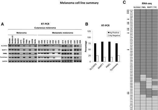 SLC45A2: A Melanoma Antigen with High Tumor Selectivity and Reduced ...