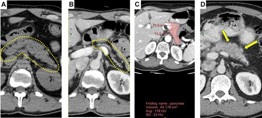 Clinical Significance of Pancreatic Atrophy Induced by Immune ...