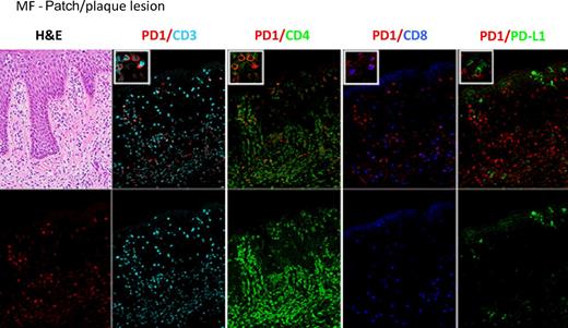 Primary T Cells from Cutaneous T-cell Lymphoma Skin Explants Display an ...