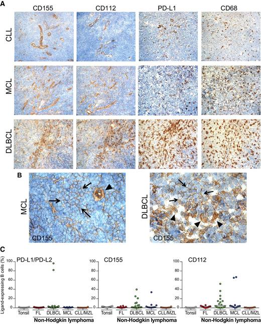 TIGIT and PD-1 Mark Intratumoral T Cells with Reduced Effector Function ...
