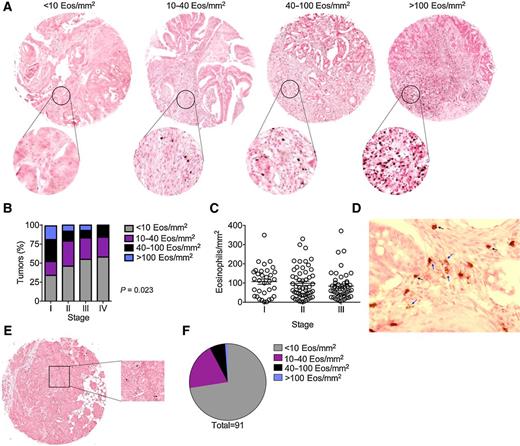 Activated Eosinophils Exert Antitumorigenic Activities in Colorectal ...