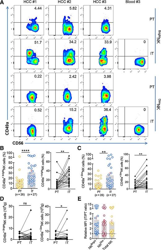 Accumulation of Tumor-Infiltrating CD49a+ NK Cells Correlates with Poor ...