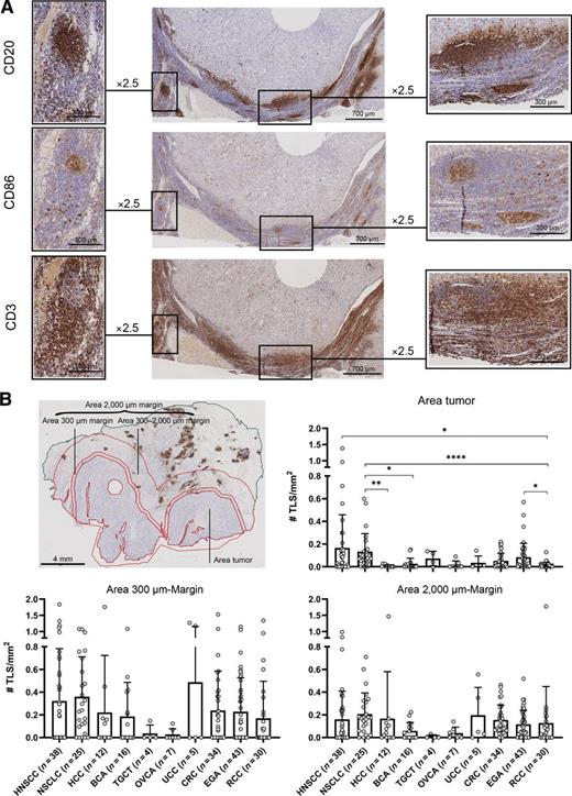 CD86+ Antigen-Presenting B Cells Are Increased in Cancer, Localize in ...