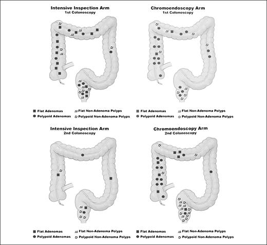 Chromoendoscopy Detects More Adenomas than Colonoscopy Using Intensive ...