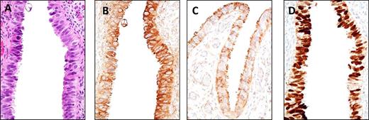 Fallopian Tube Lesions in Women at High Risk for Ovarian Cancer: A ...