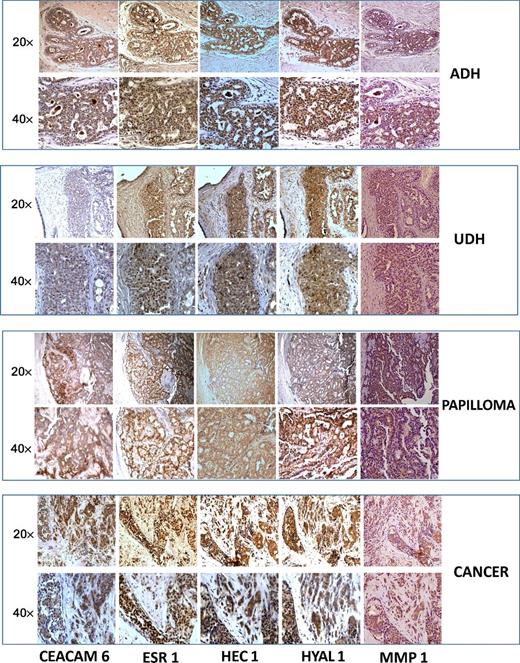 Breast Hyperplasias, Risk Signature, and Breast Cancer | Cancer ...