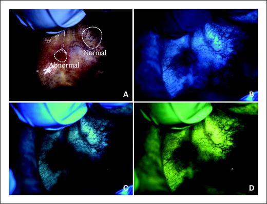 Objective Detection and Delineation of Oral Neoplasia Using ...
