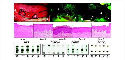 Tracing the “At-Risk” Oral Mucosa Field with Autofluorescence: Steps ...