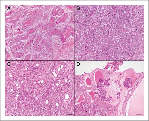 Evidence of a Chemopreventive Effect of Progestin Unrelated to ...